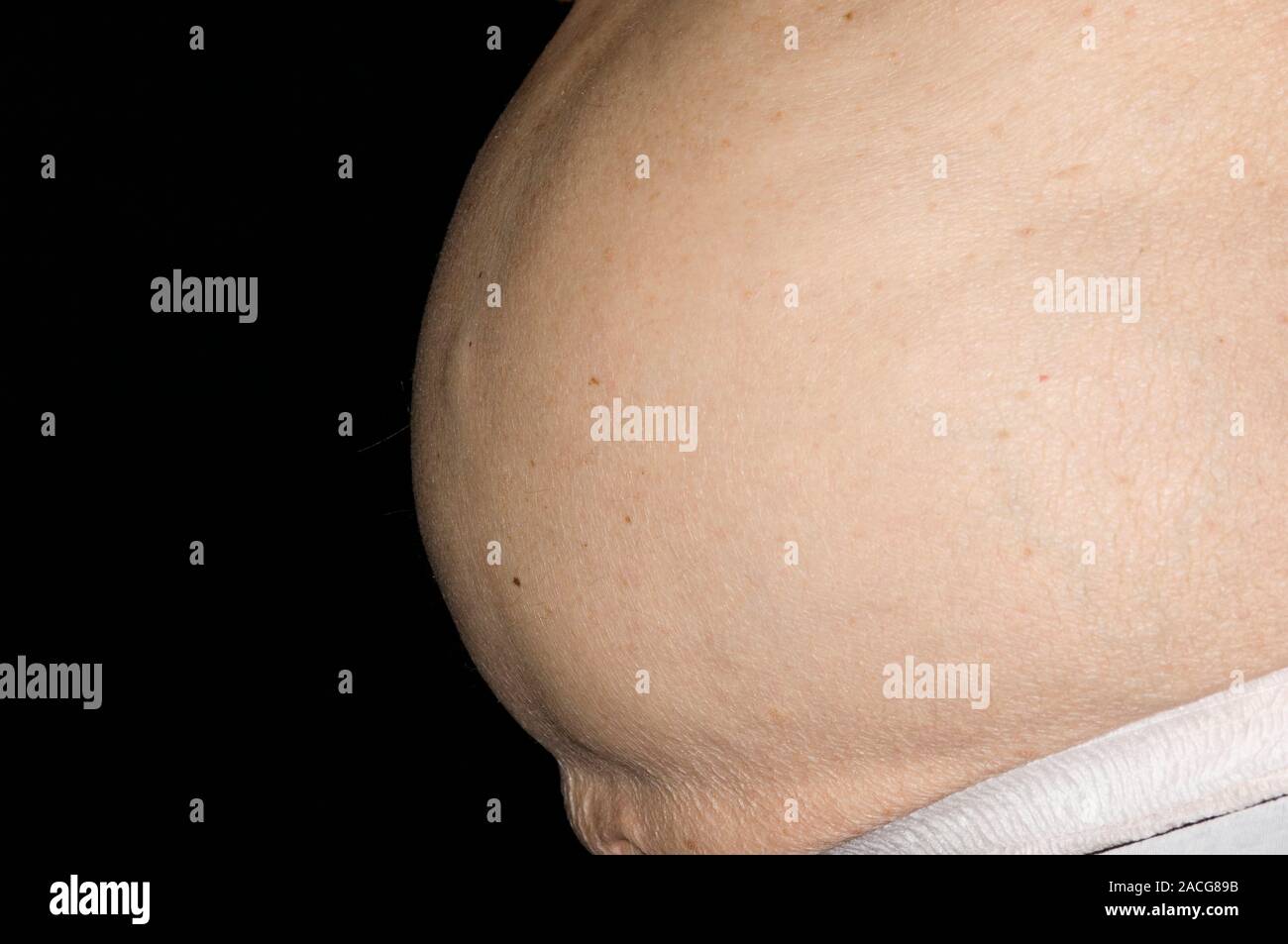 Distended abdomen of an elderly male patient with non-Hodgkins lymphoma ...