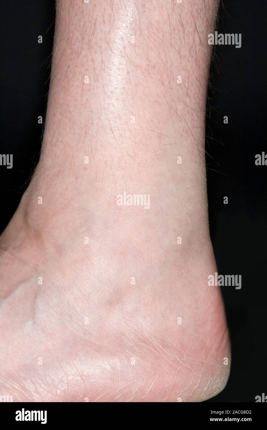 Foot of an adult male patient, showing the partial rupture to the ...