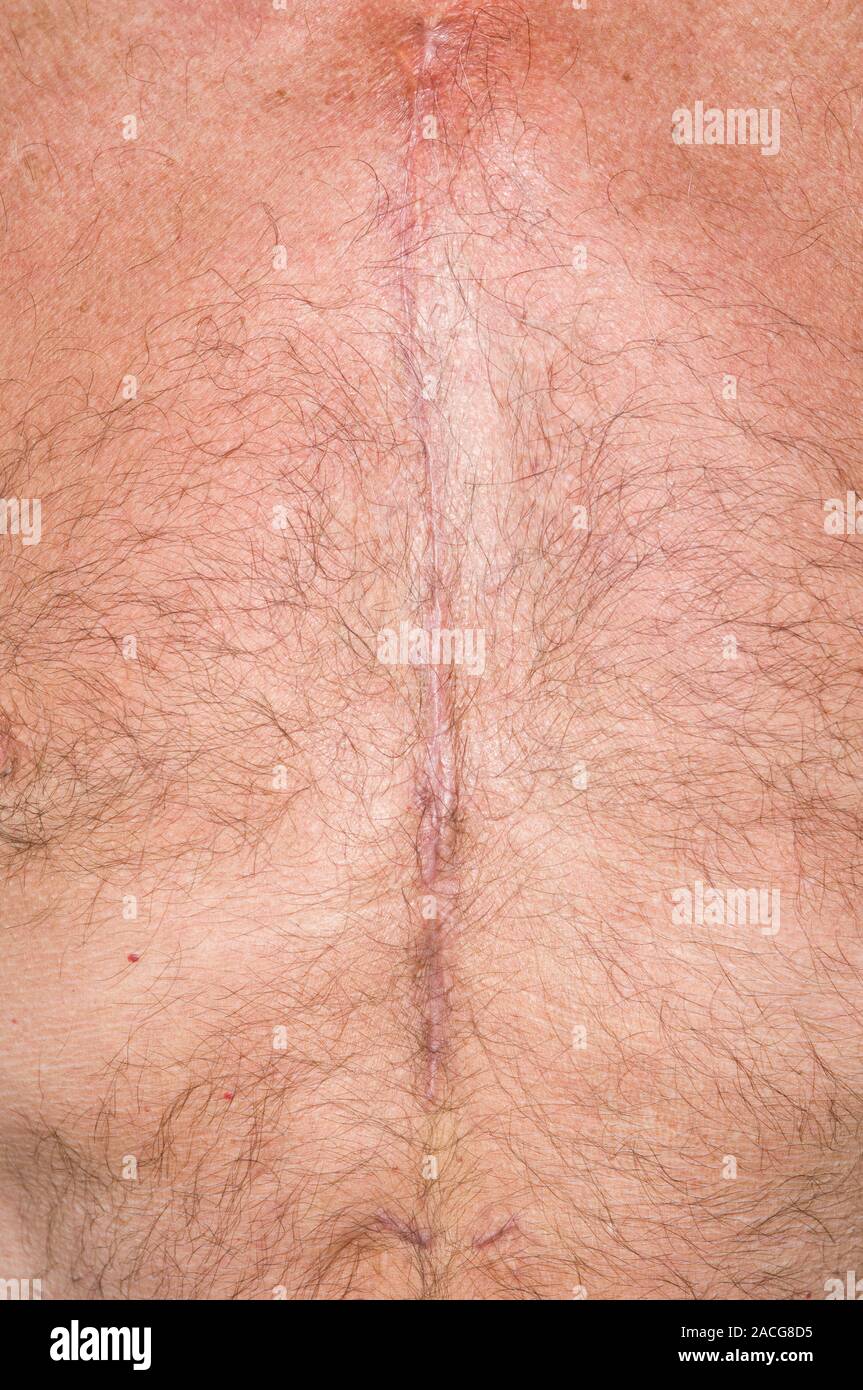Scar on the chest of a 74 year old male patient, three months after ...