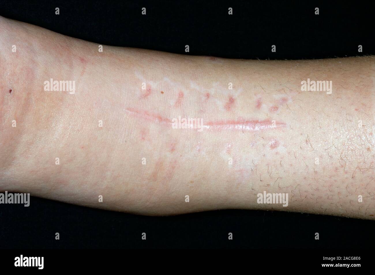 Scar on the ankle of an adult patient, after internal fixation to treat ...