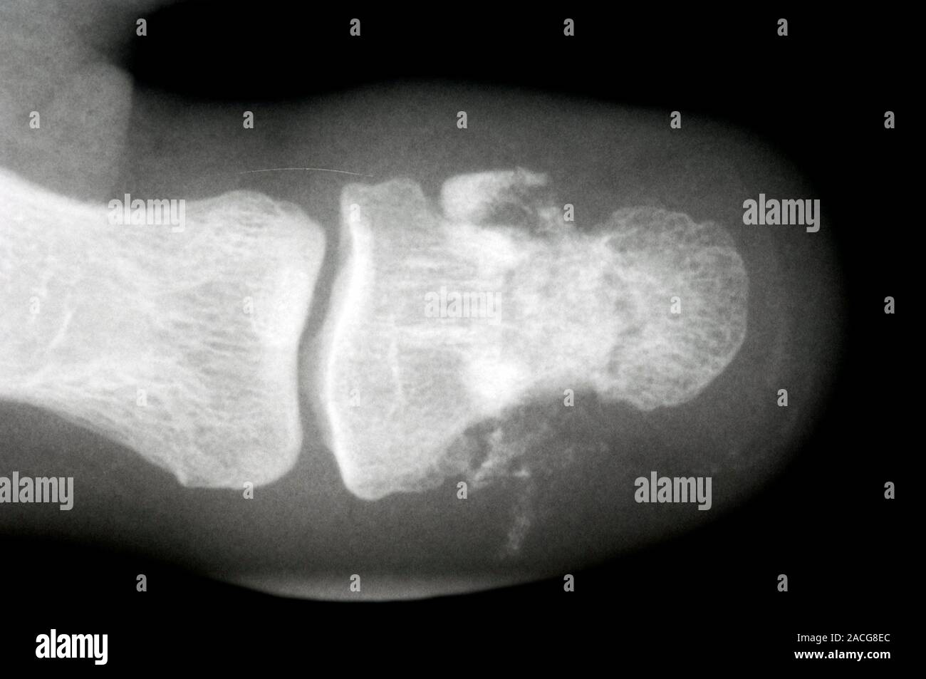 X-ray of the great toe of an adult male patient, showing a compound ...