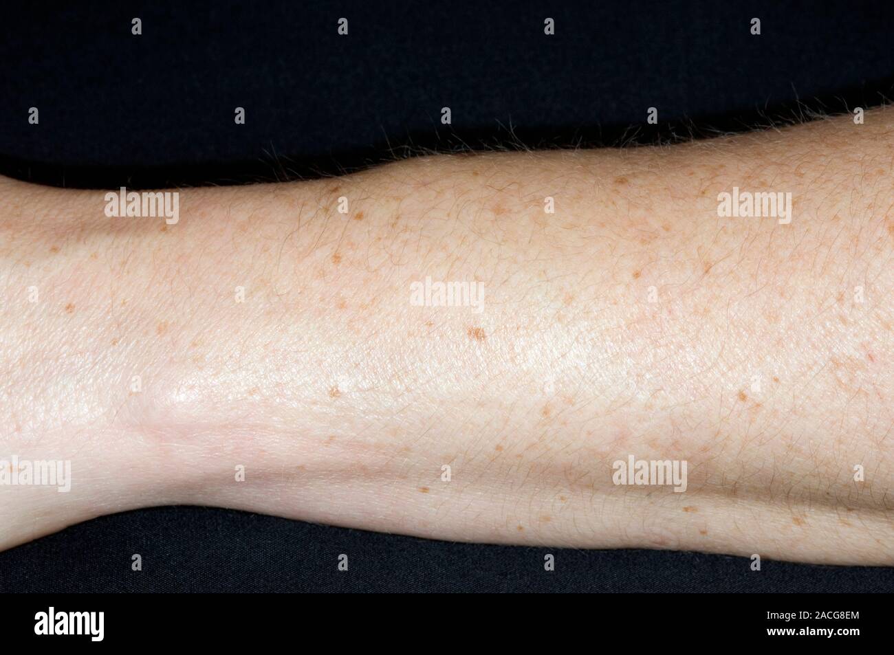 Forearm of an adult female patient, showing tendon inflammation from ...
