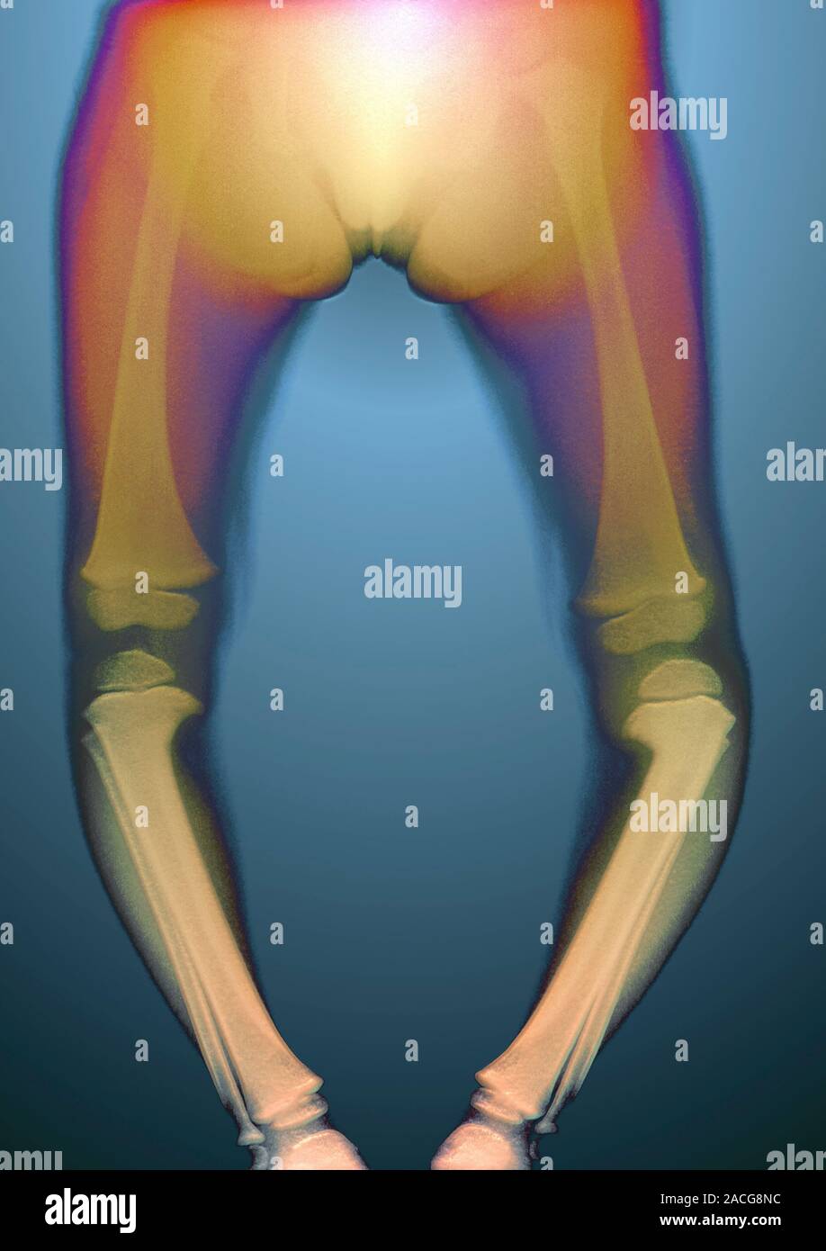 Coloured X Ray Front View Of The Lower Limbs Of An Infant Showing