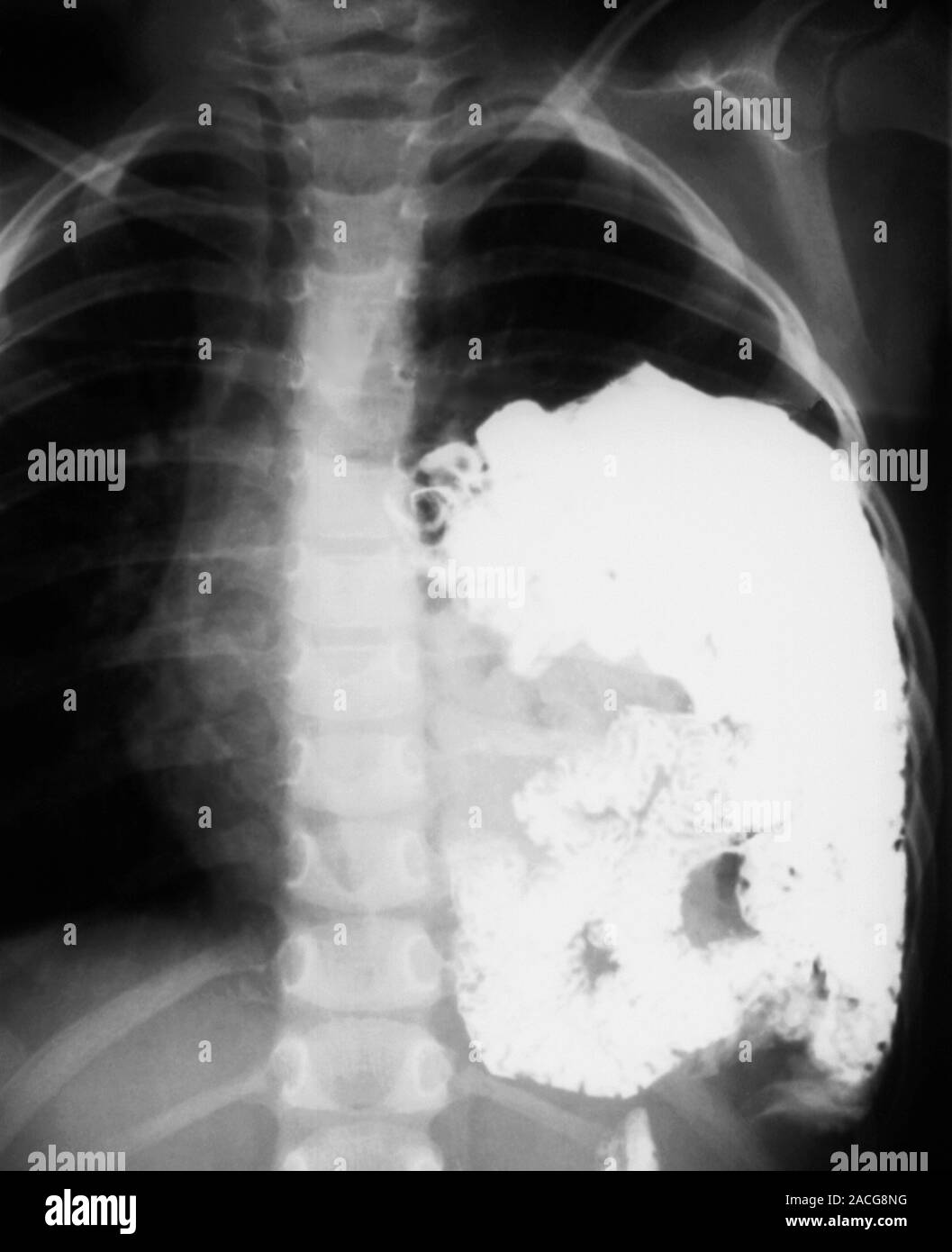 X-ray (front view) of the chest of a 3 year old patient, showing a ...