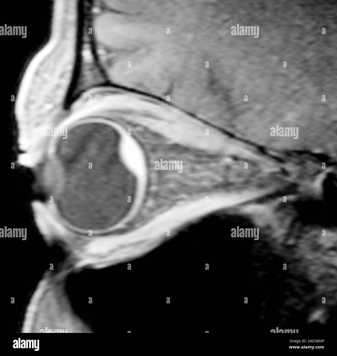 Magnetic Resonance Imaging (MRI) scan in sagittal view through the ...
