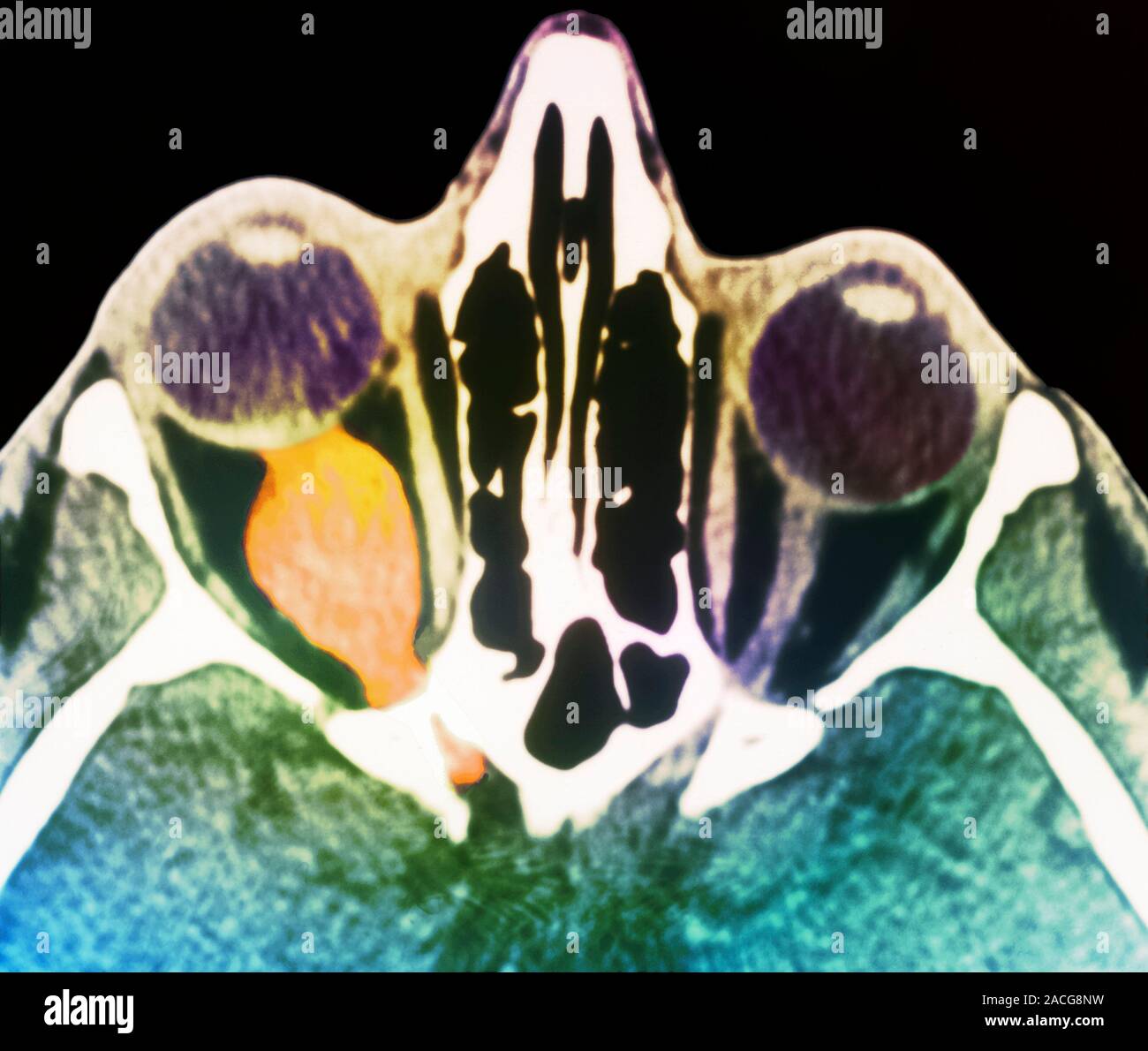 Coloured Computed Tomography (CT) scan in axial section through the ...