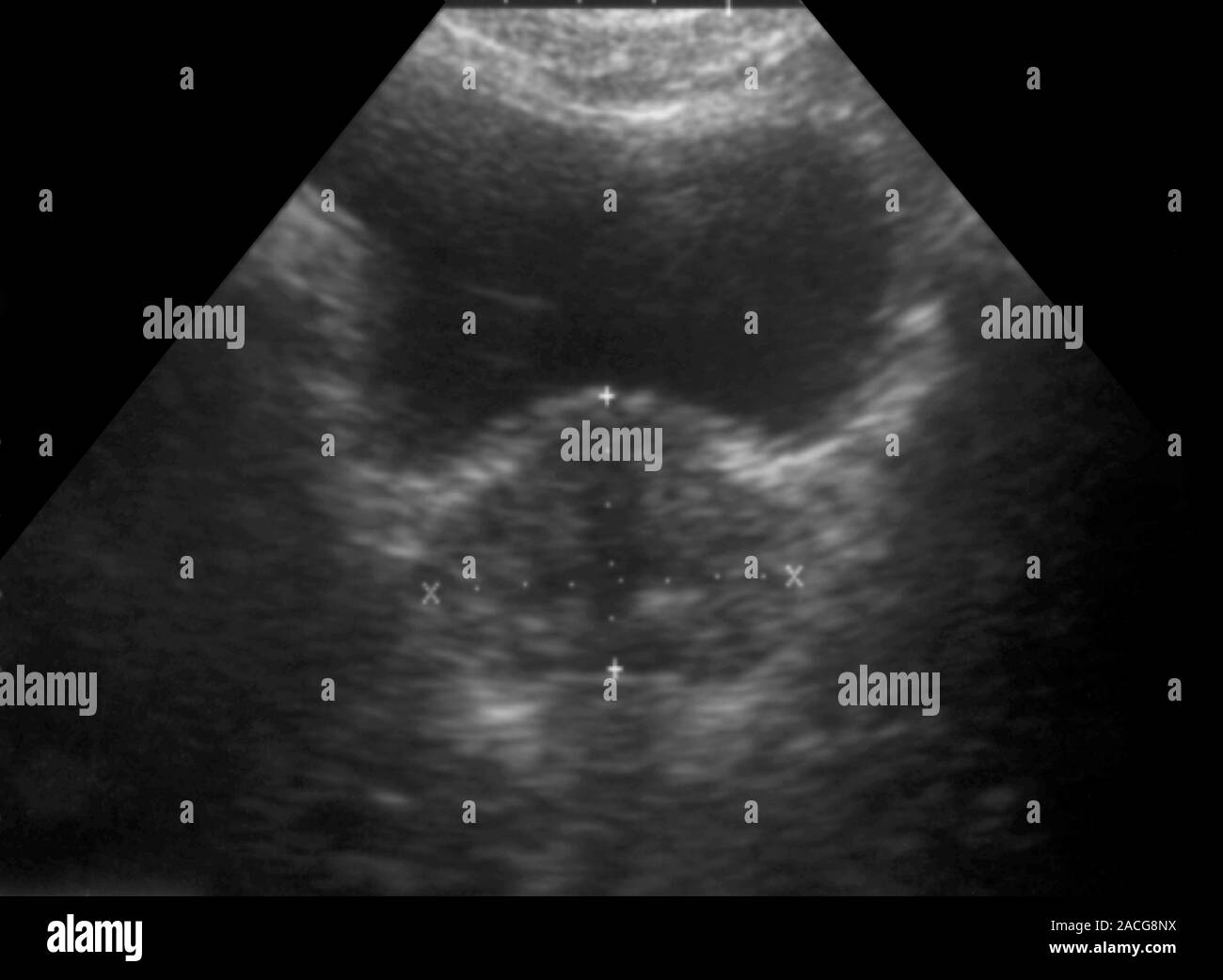 Ultrasound scan (transverse view) of the pelvis of a 46 year old male ...