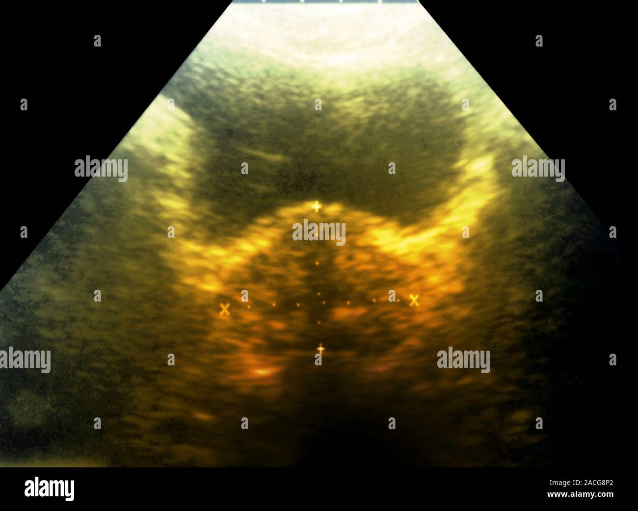 Coloured Ultrasound Scan Transverse View Of The Pelvis Of A 46 Year Old Male Patient Showing