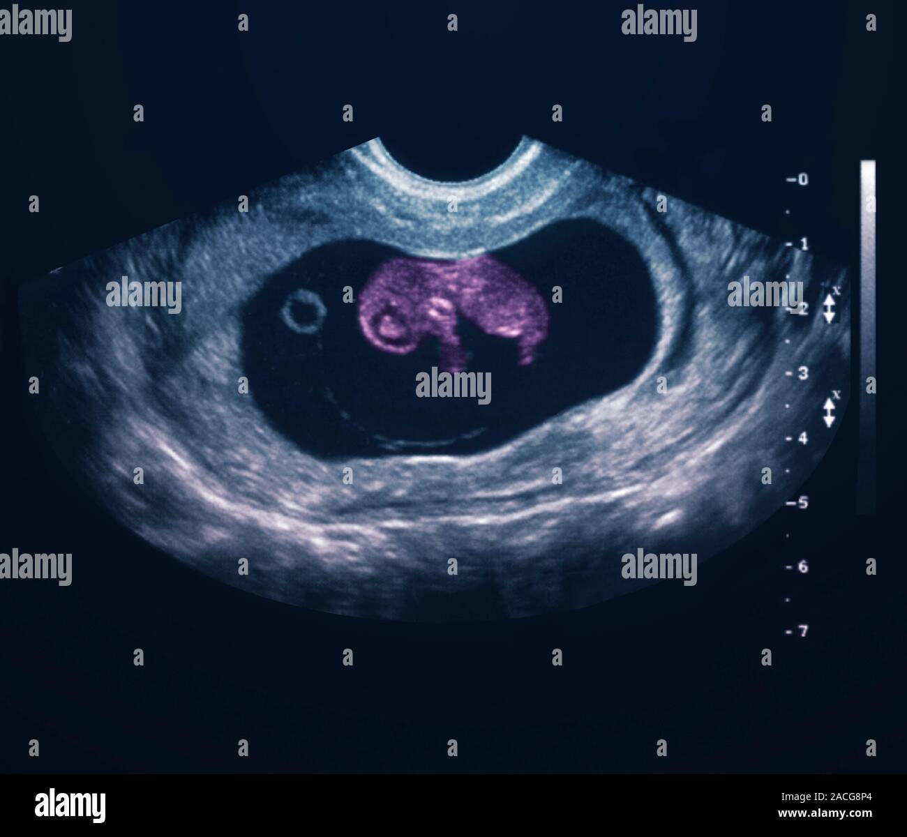 Coloured ultrasound scan of the abdomen of a pregnant female patient ...