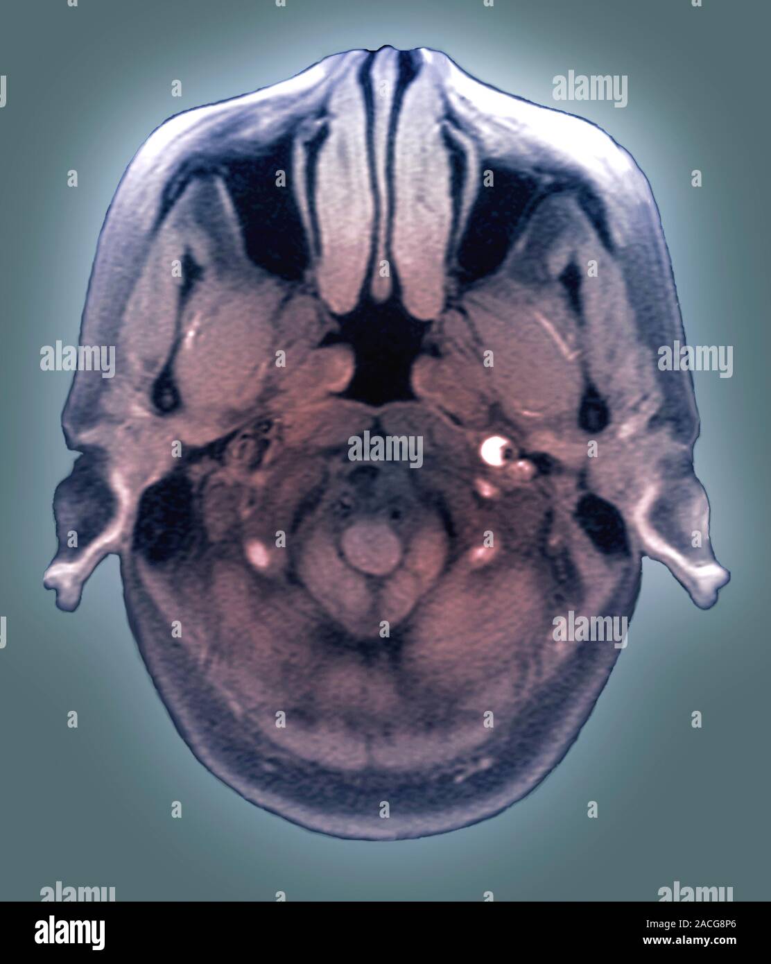 Coloured Magnetic Resonance Imaging (MRI) angioscan of an axial section ...