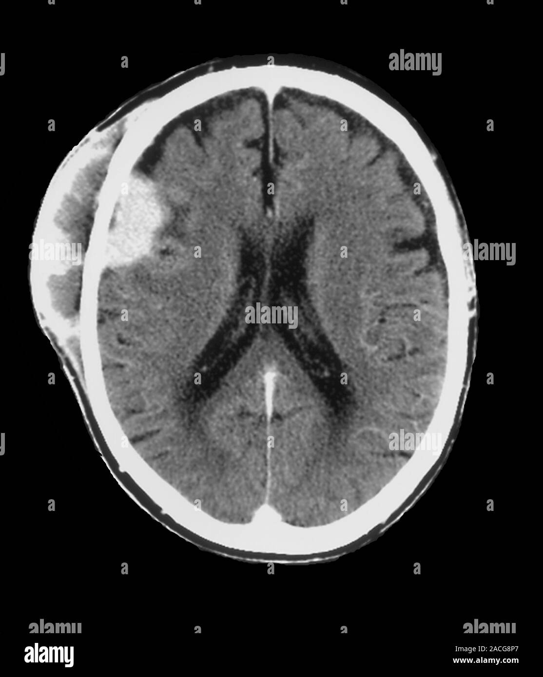 Computed Tomography (CT) scan in axial section through the head of an ...