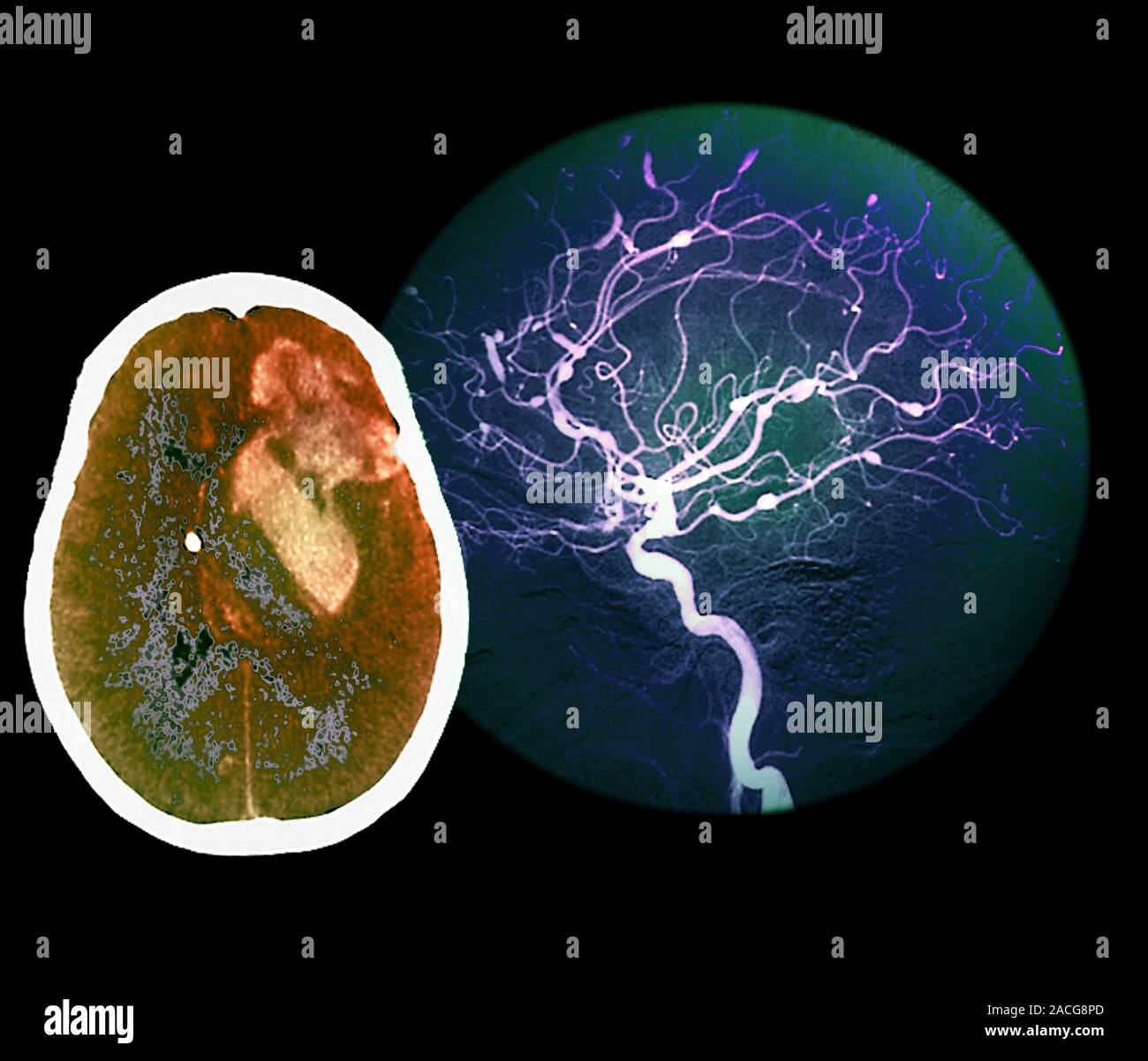 Coloured Computed Tomography (CT) scan of an axial section through the head of a young African ...