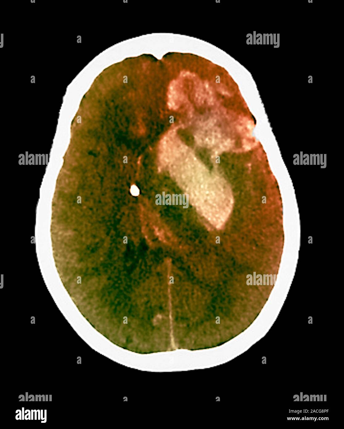 Coloured Computed Tomography (CT) scan of an axial section through the head of a young African ...