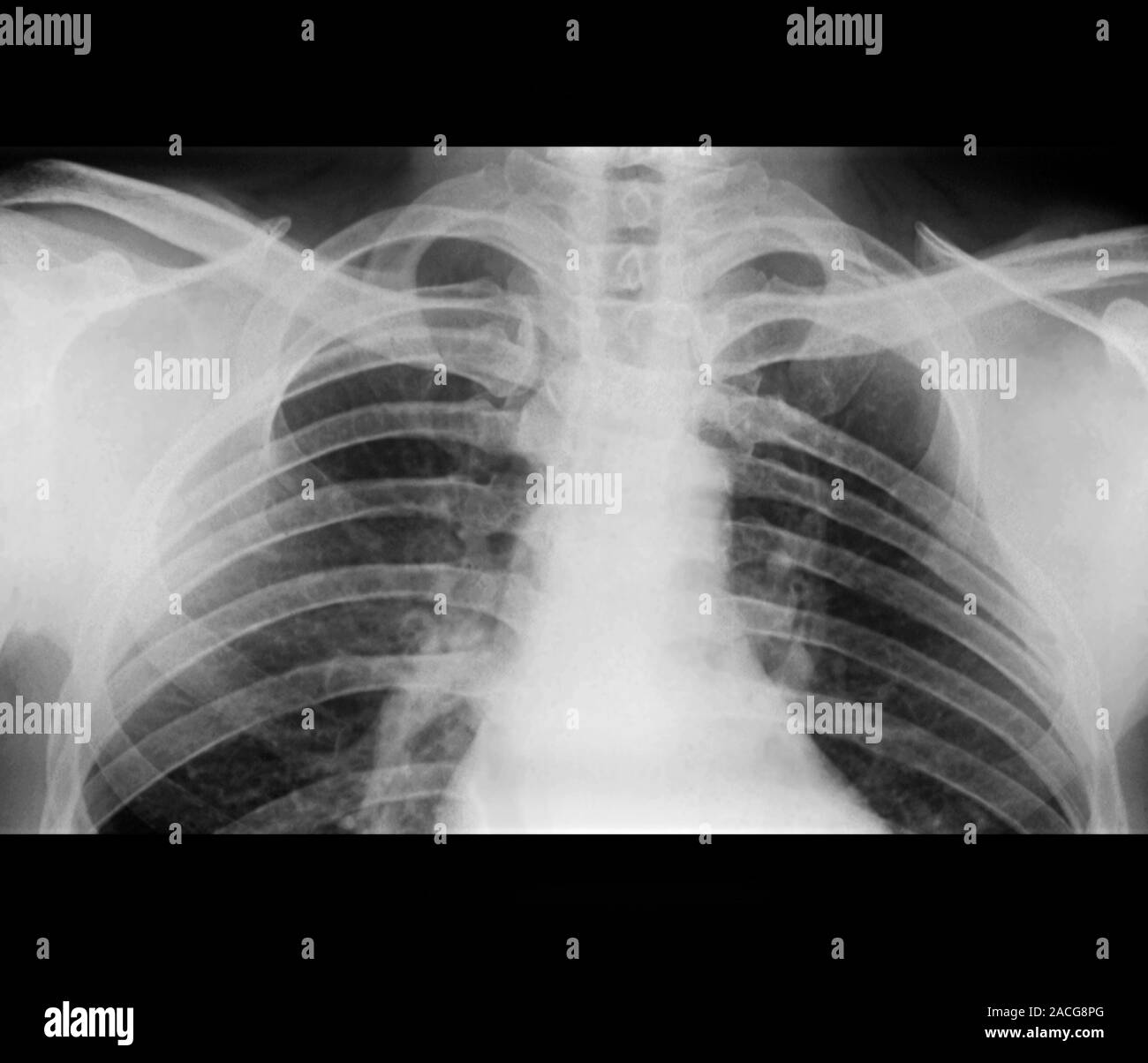 X-ray (front view) of the chest of a patient, showing the absence of ...