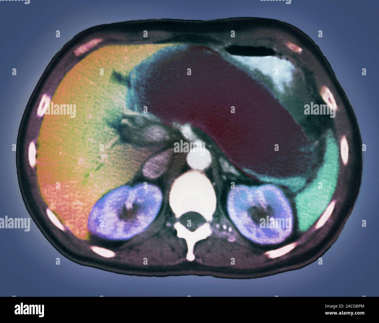 Coloured Computed Tomography (CT) scan in axial section through the abdomen of a 45 year old ...