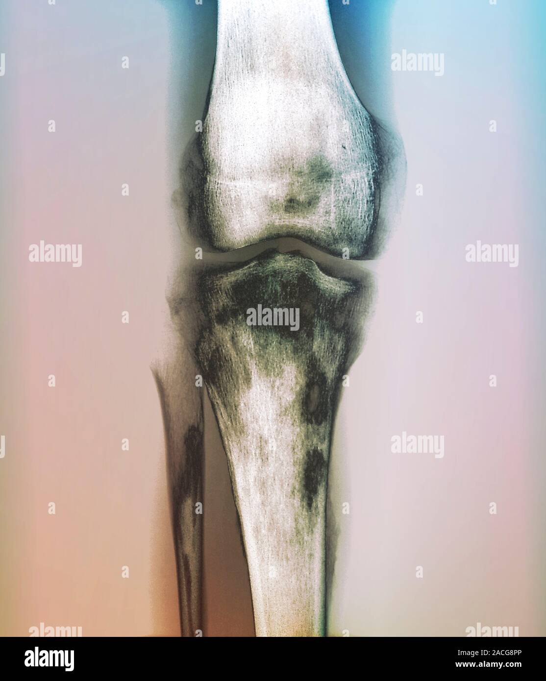 Coloured X-ray (front view) of the bones of the knee of a 39 year old ...