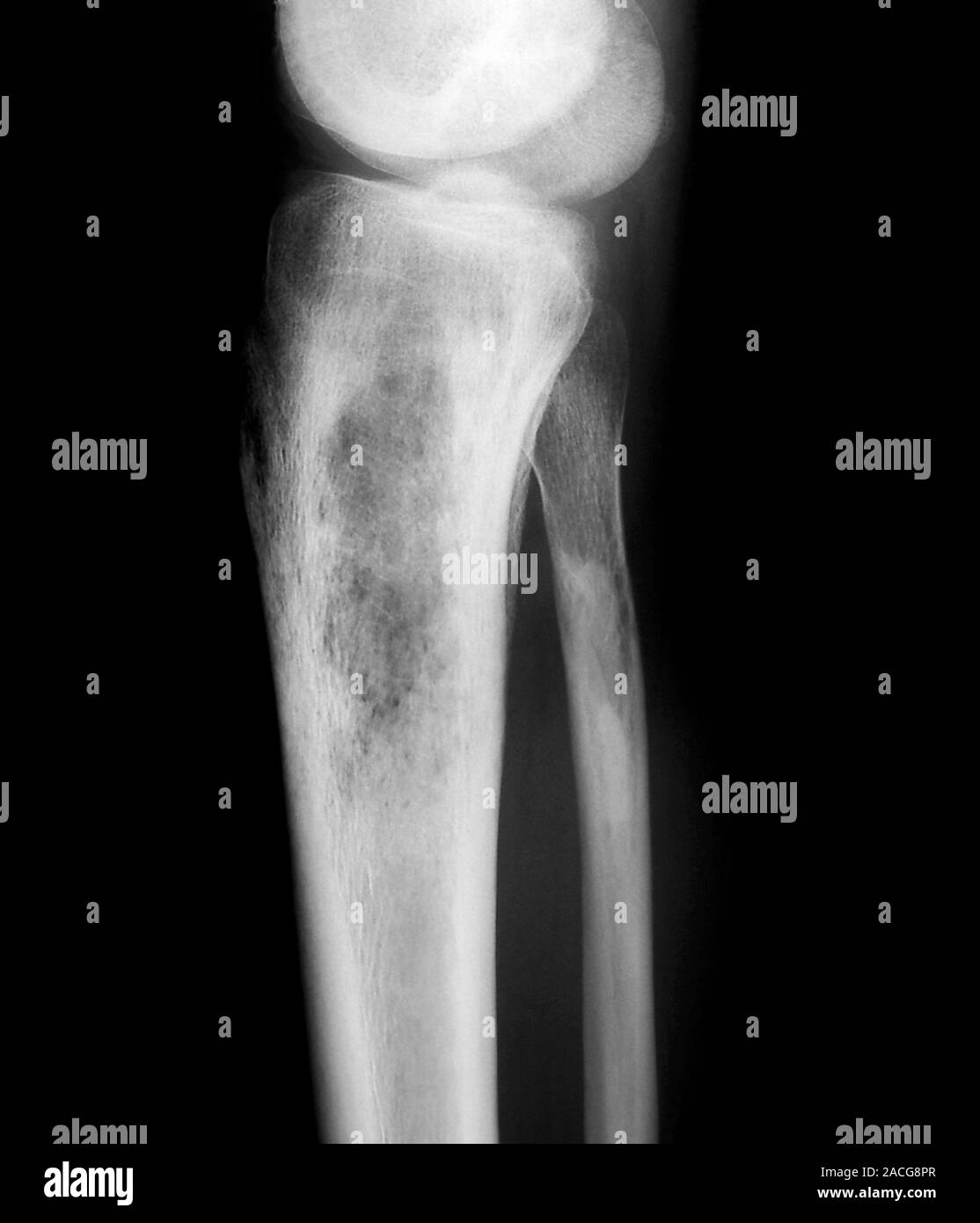 X-ray (side view) of the bones of the knee of a 39 year old patient ...