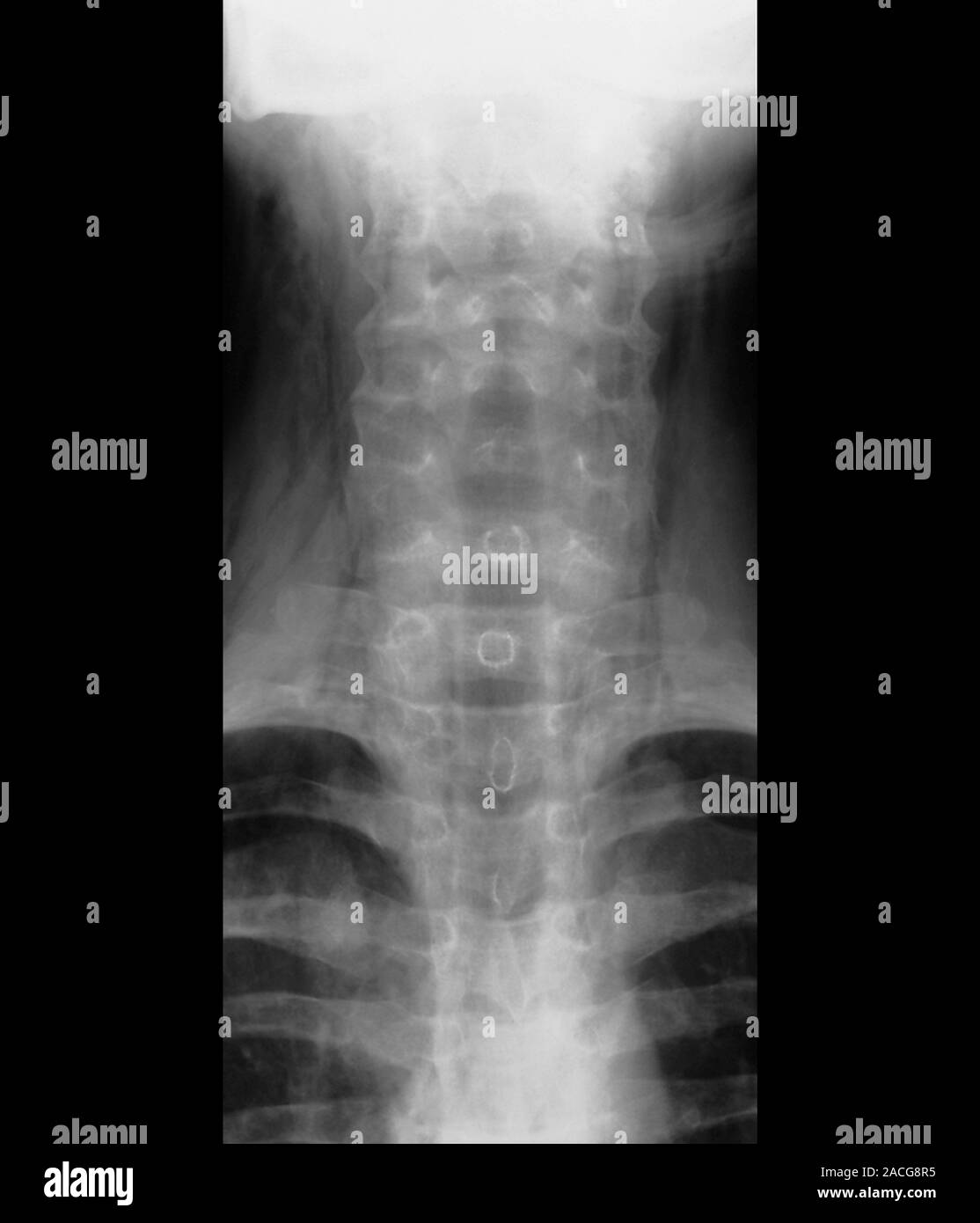 X-ray (front view) of the cervical spine of the neck in a 16 year old ...