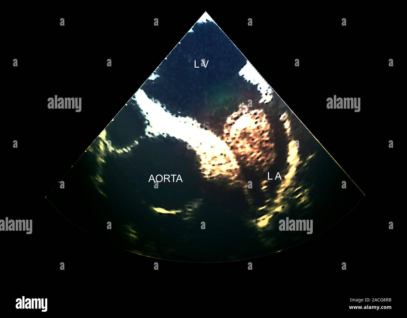 Coloured ultrasound scan of the heart of a 60 year old patient, showing ...