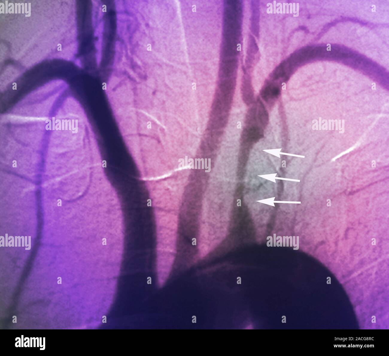 Coloured digitised angiogram (X-ray) of arteries near the heart in a 63 ...