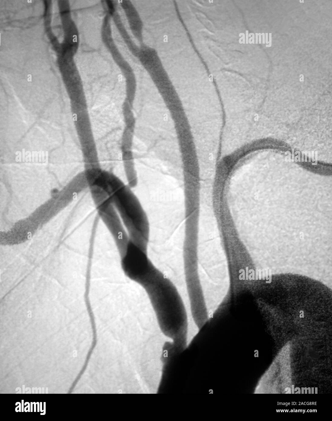 Digitised angiogram (X-ray) of arteries branching from the aorta of the ...