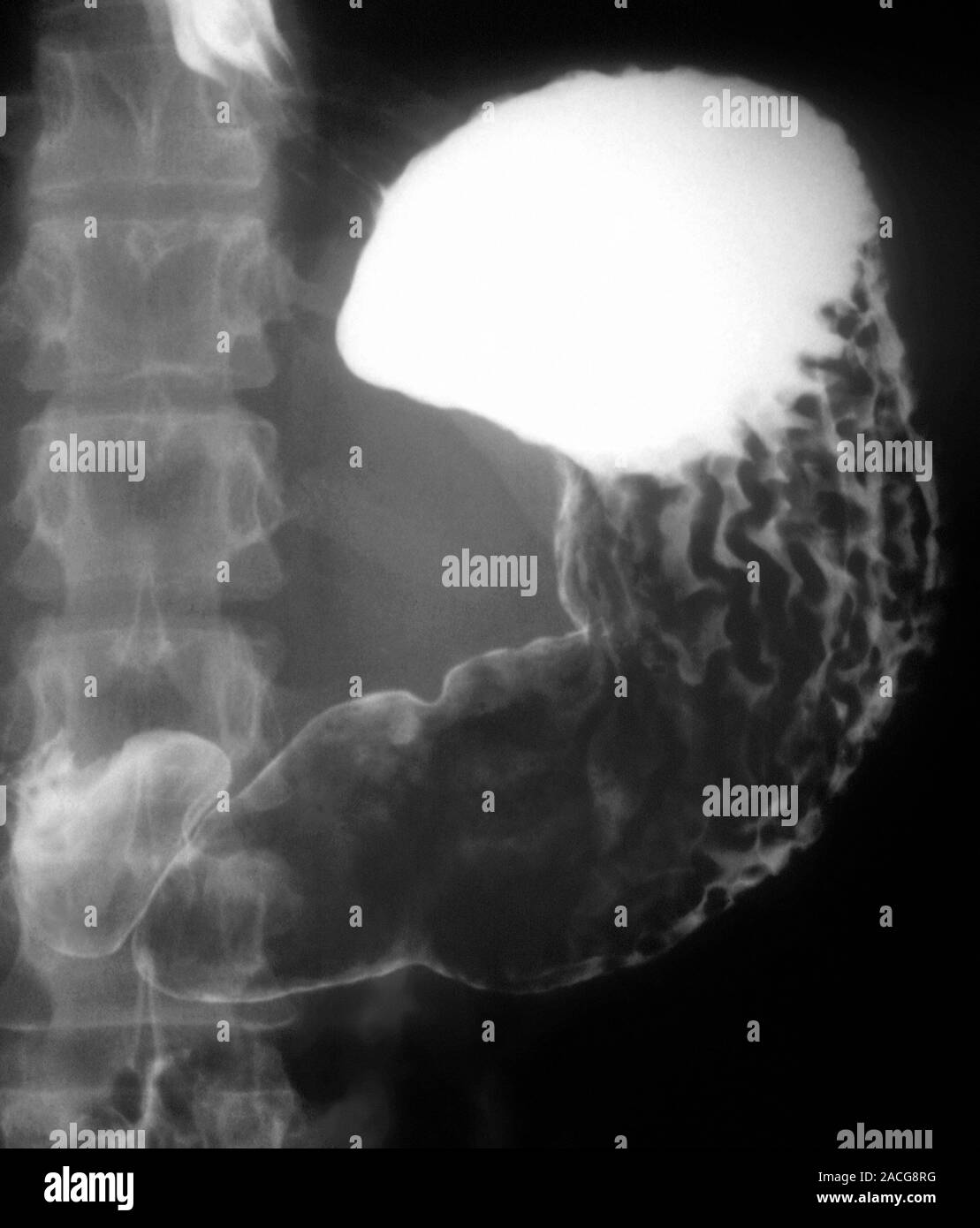 Barium X-ray of the abdomen of a patient, showing the healthy stomach ...
