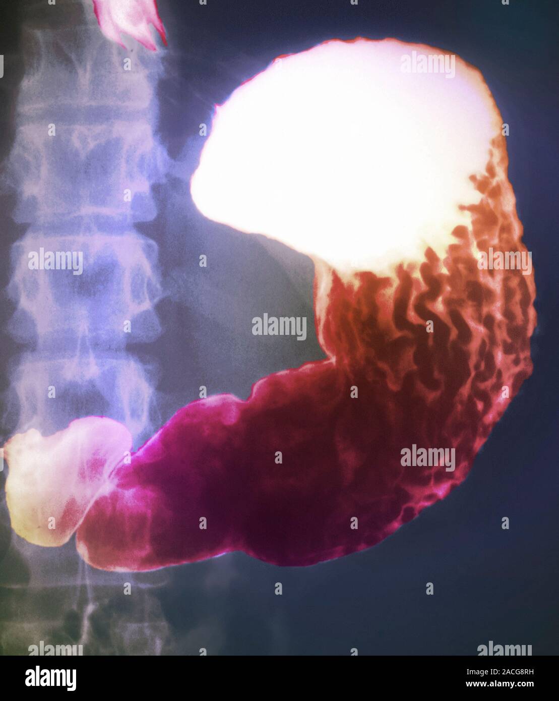 Coloured barium X-ray of the abdomen of a patient, showing the healthy ...