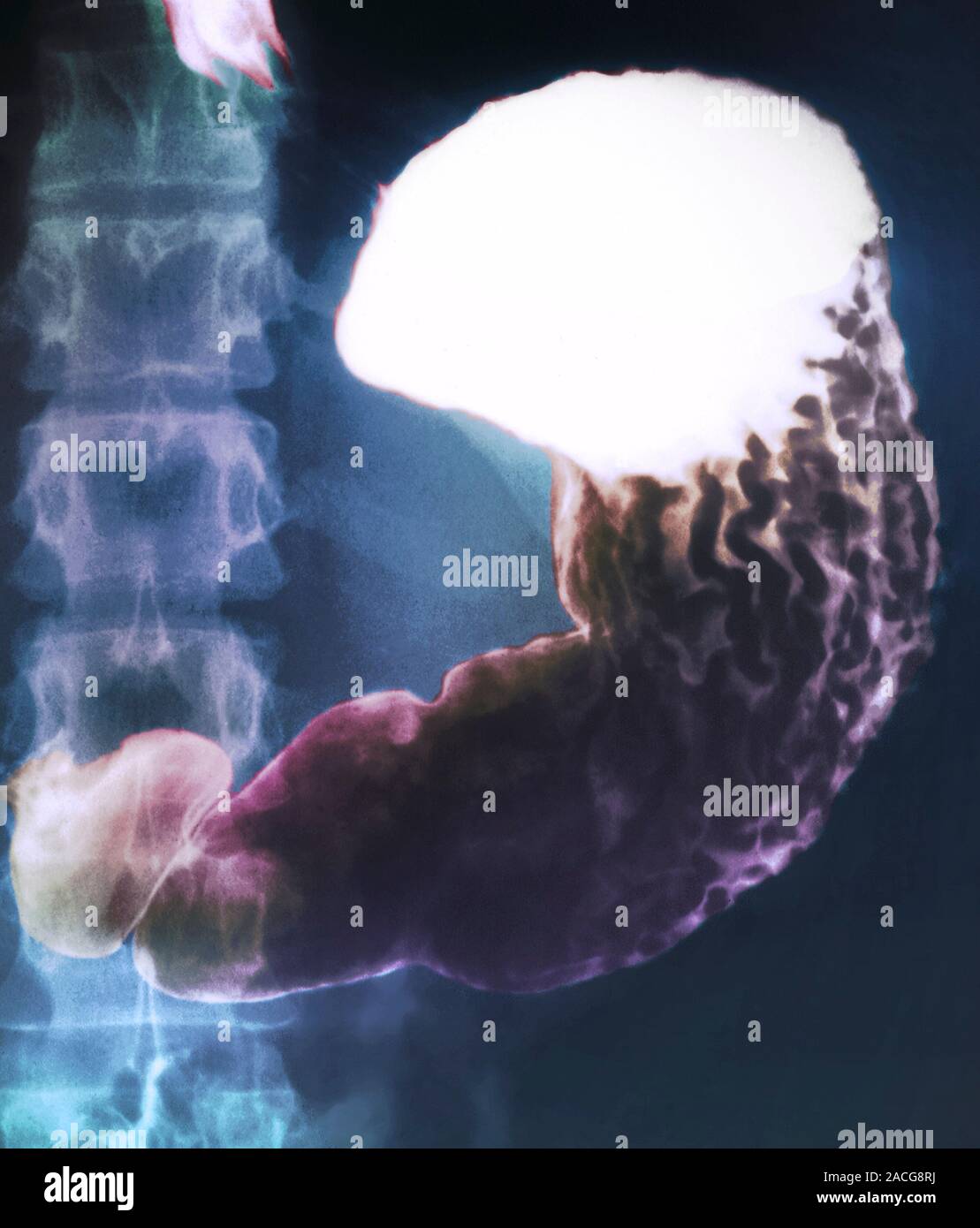 Coloured barium X-ray of the abdomen of a patient, showing the healthy ...