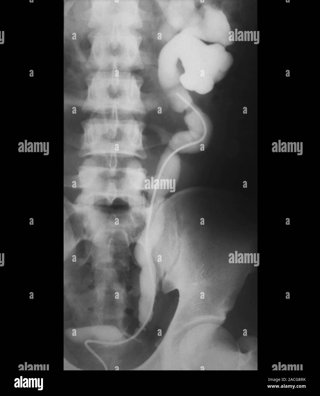 Urogram (X-ray) of the abdomen in a young patient showing a ureterocele ...