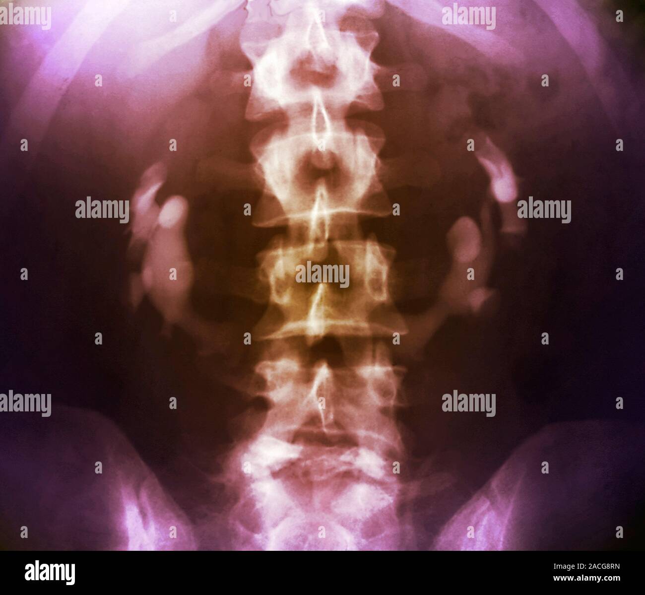 Coloured urogram (X-ray) of the abdomen in a young patient, showing the ...