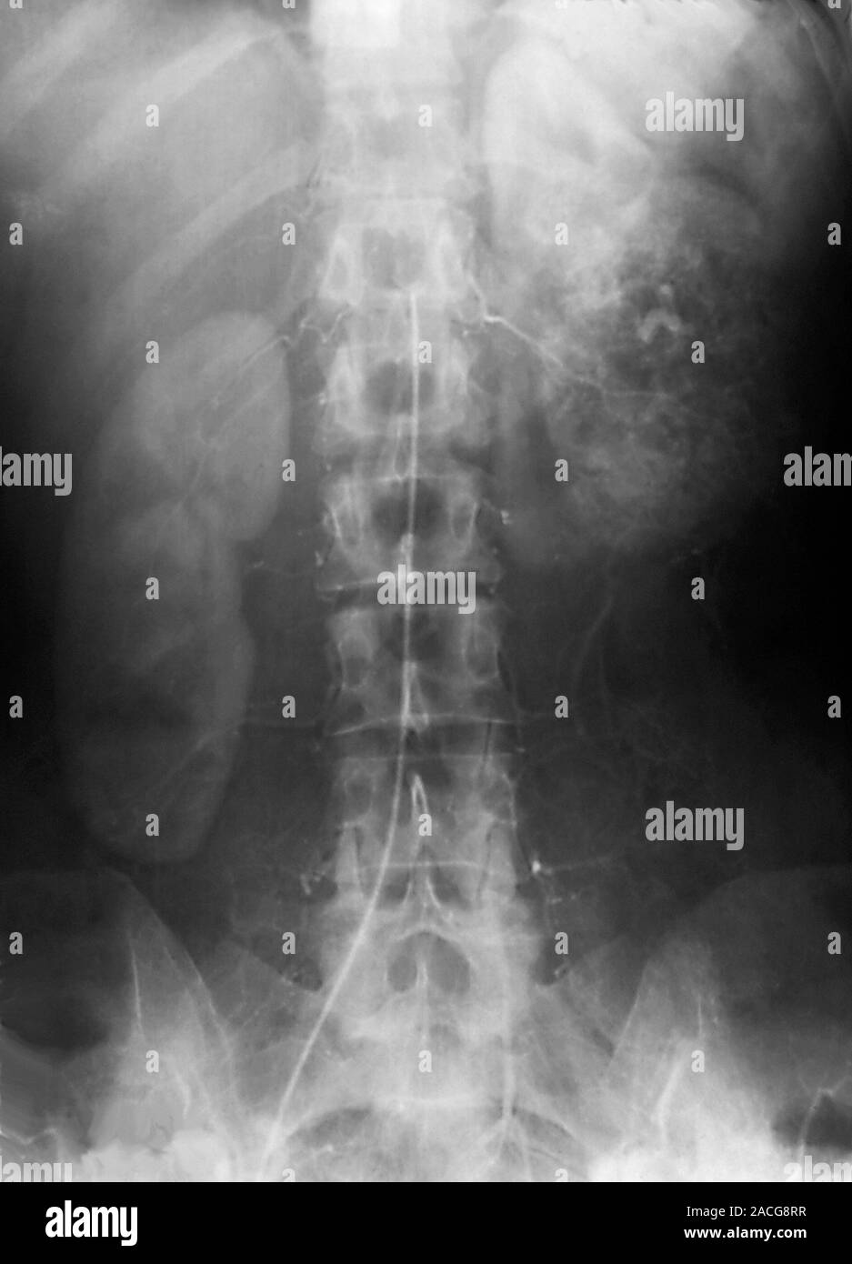 Renal angiogram (X-ray) of the abdomen of a patient, showing blood ...
