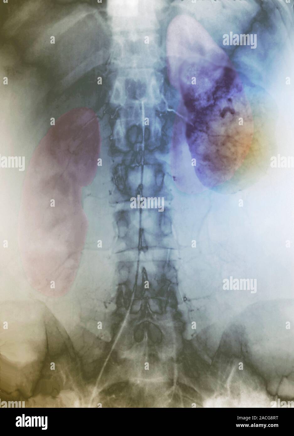 Coloured renal angiogram (X-ray) of the abdomen of a patient, showing ...