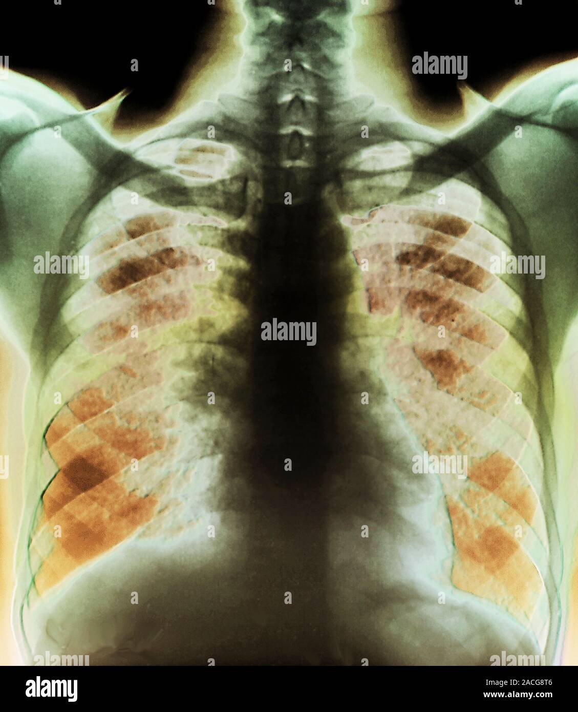 Coloured X-ray of the chest of a patient, showing the lungs filled with ...