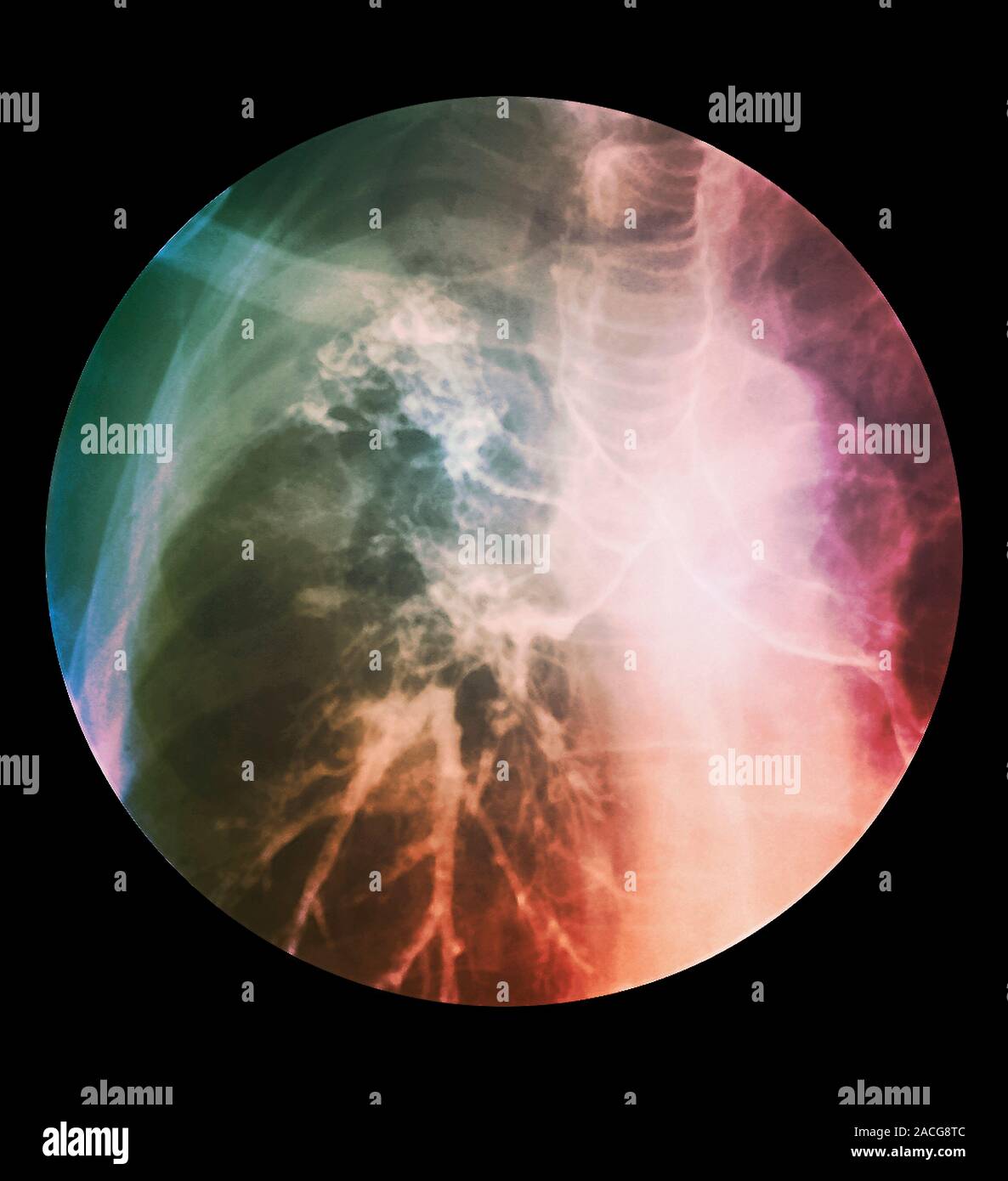Coloured bronchography (X-ray) of the chest of a patient, showing ...