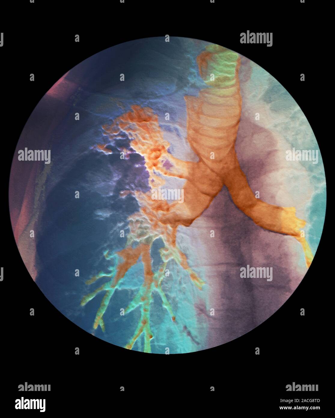 Coloured bronchography (X-ray) of the chest of a patient, showing ...