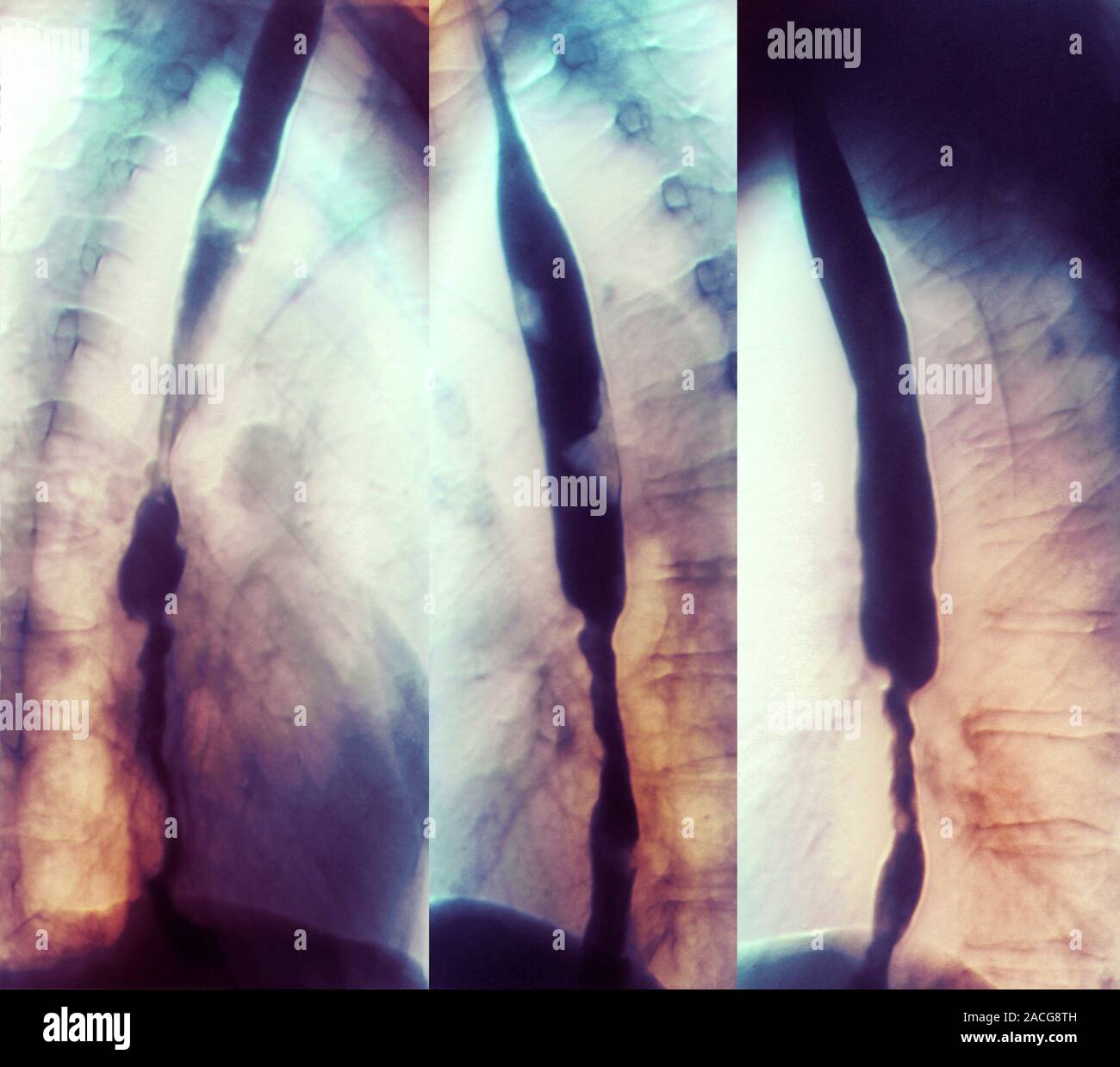 Coloured X-ray angiography (front view) of the abdomen in a patient ...