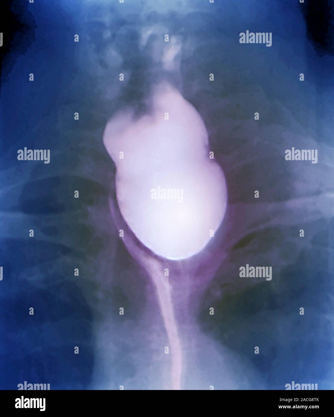 Coloured barium swallow X-ray of the upper chest of a 62 year old ...