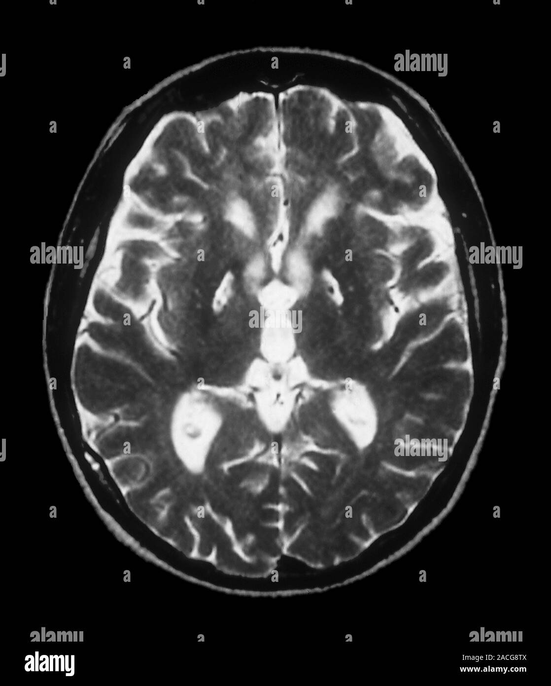 Magnetic Resonance Imaging (MRI) scan in axial section through the ...