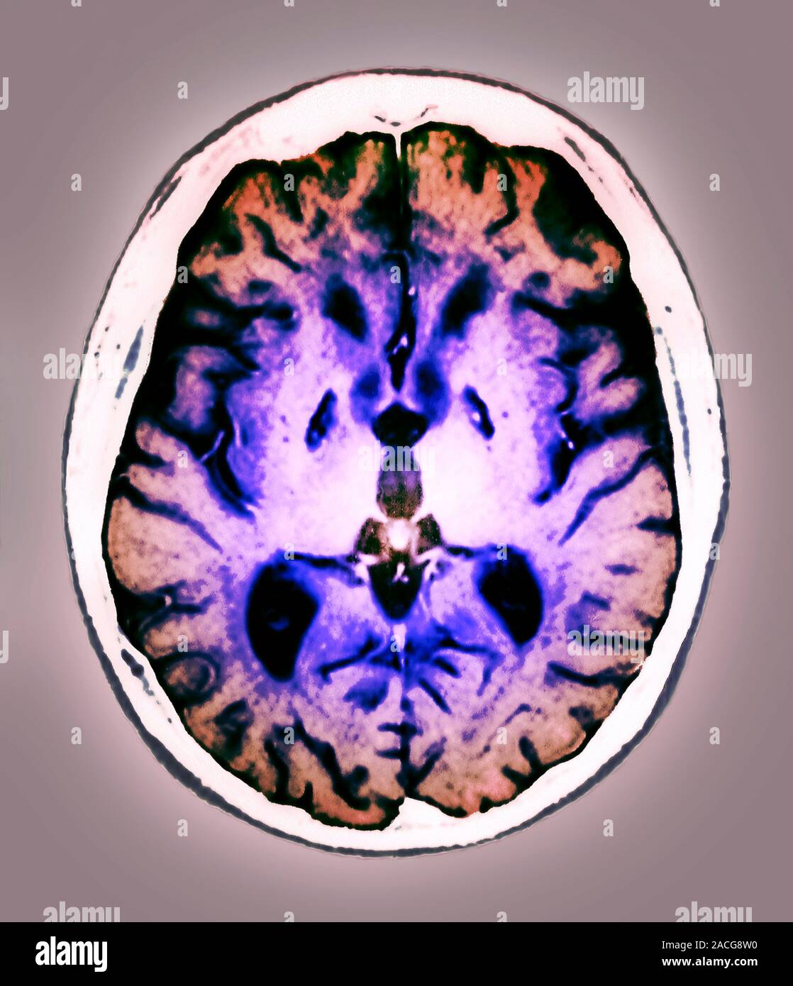 Coloured Magnetic Resonance Imaging (MRI) scan in axial section through the brain of a 43 year ...