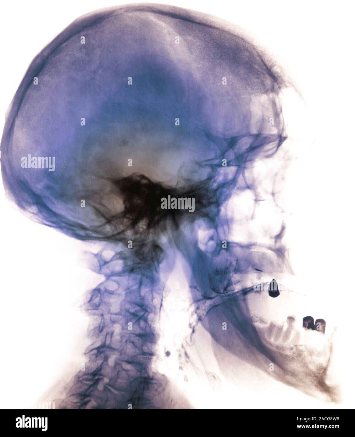 Coloured X-ray (side view) of the skull of a 43 year old patient ...