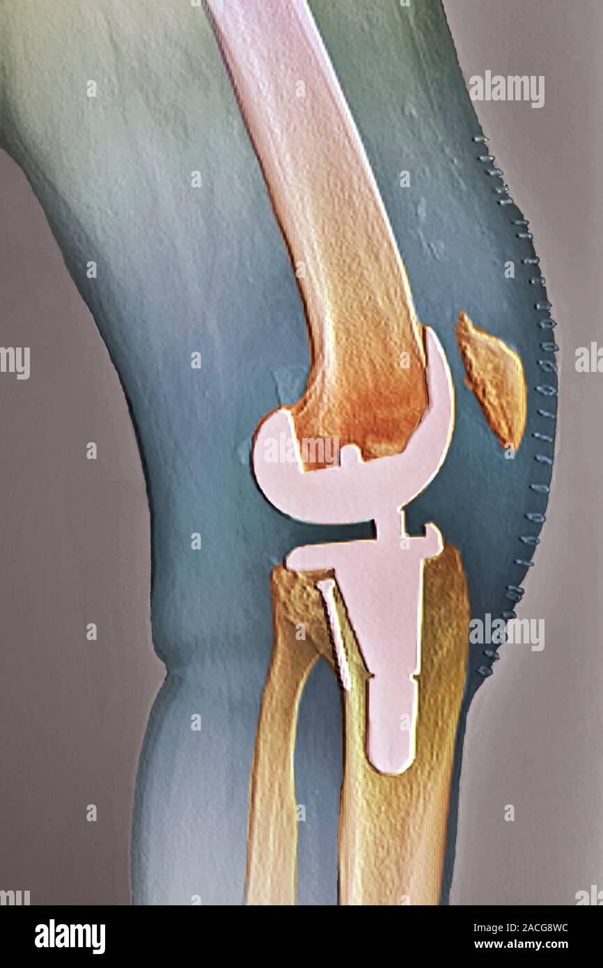 Coloured X-ray (side view) of the bones of the knee joint in a 78 year ...