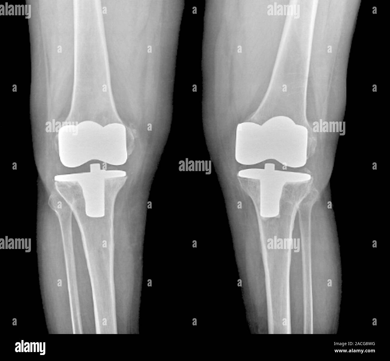 X-ray (front view) of the bones of the knees in a 61 year old patient ...