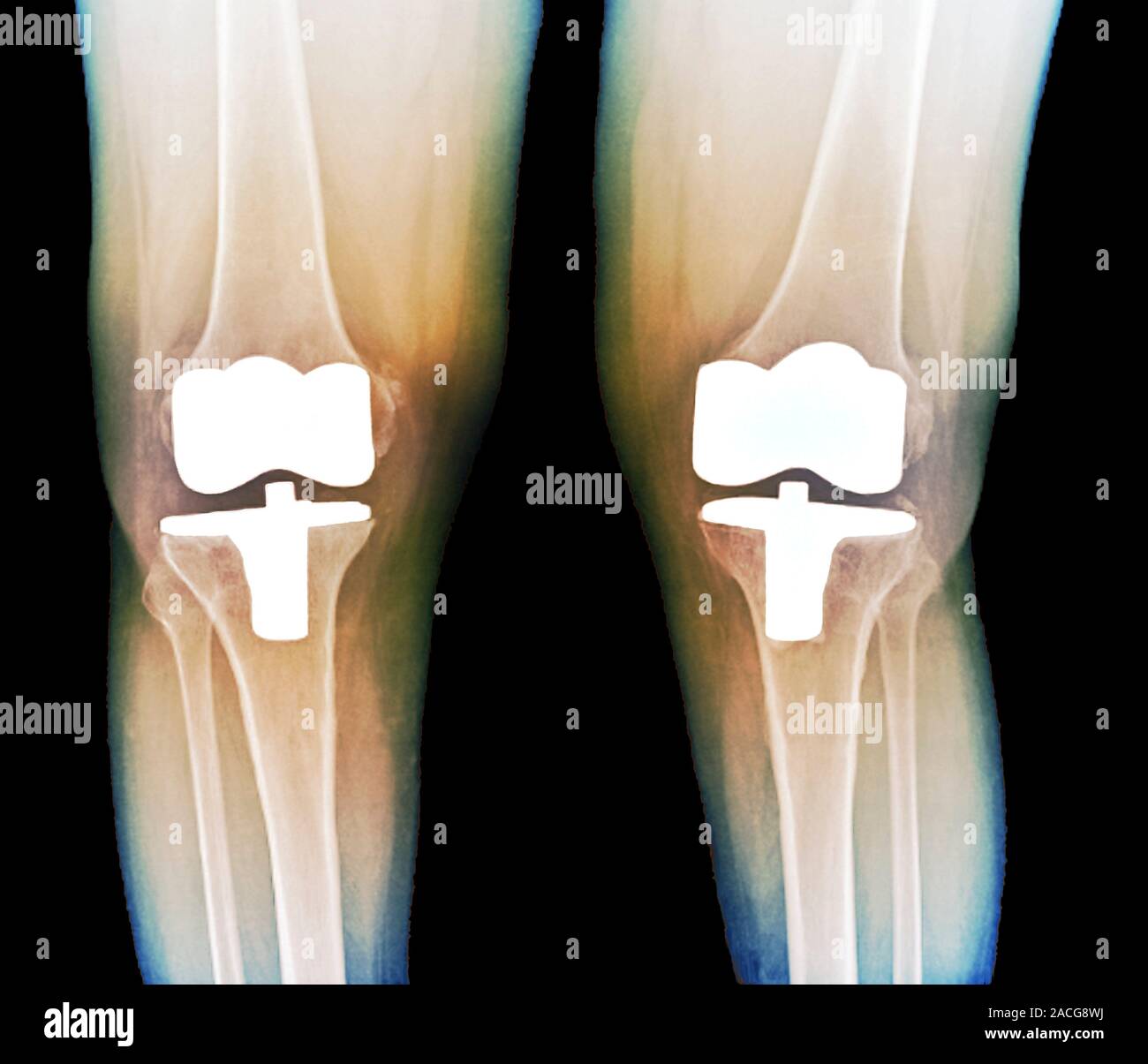 Coloured X-ray (front view) of the bones of the knees in a 61 year old ...