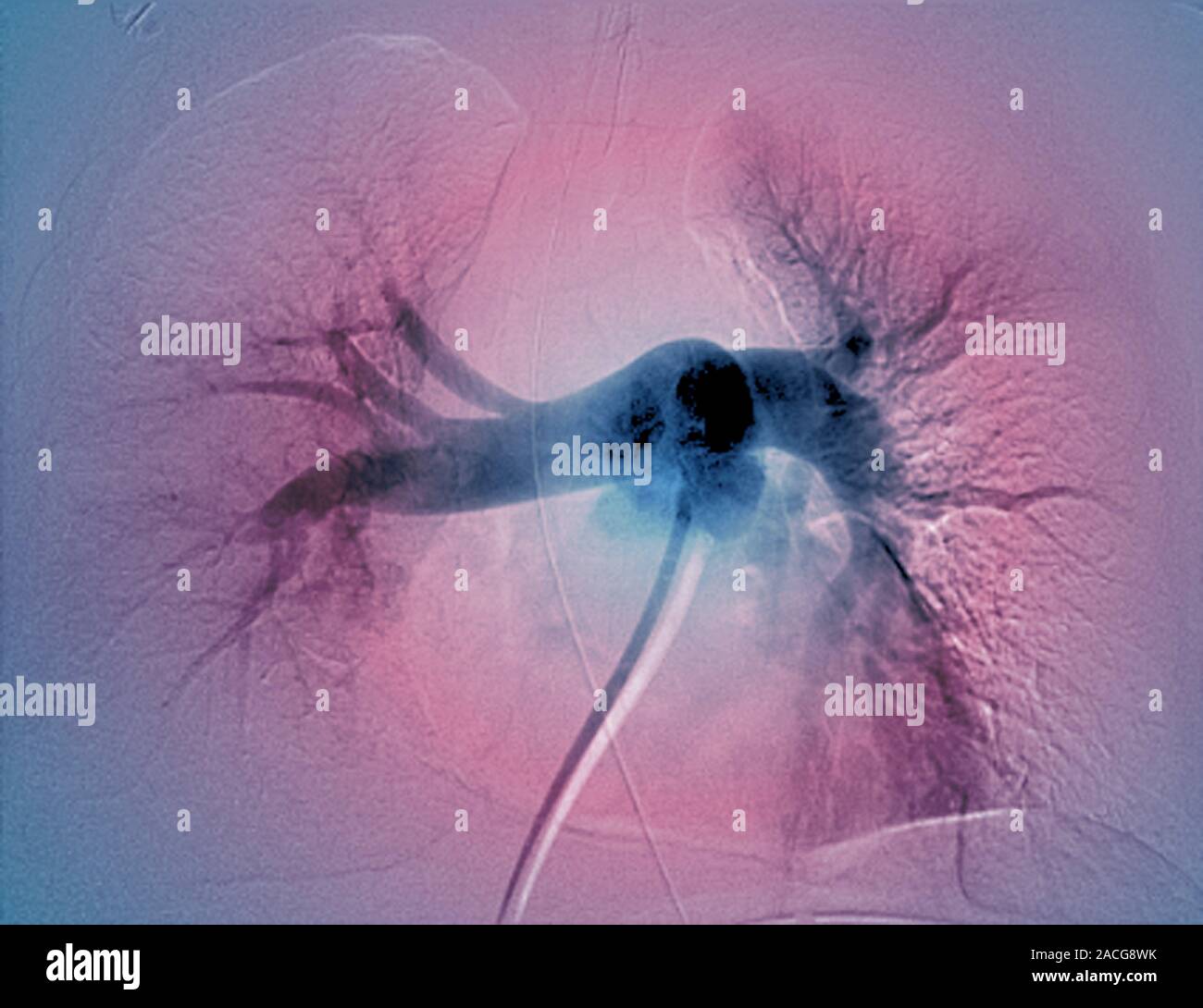 Coloured digitised pulmonary angiogram (X-ray) in front view of the ...