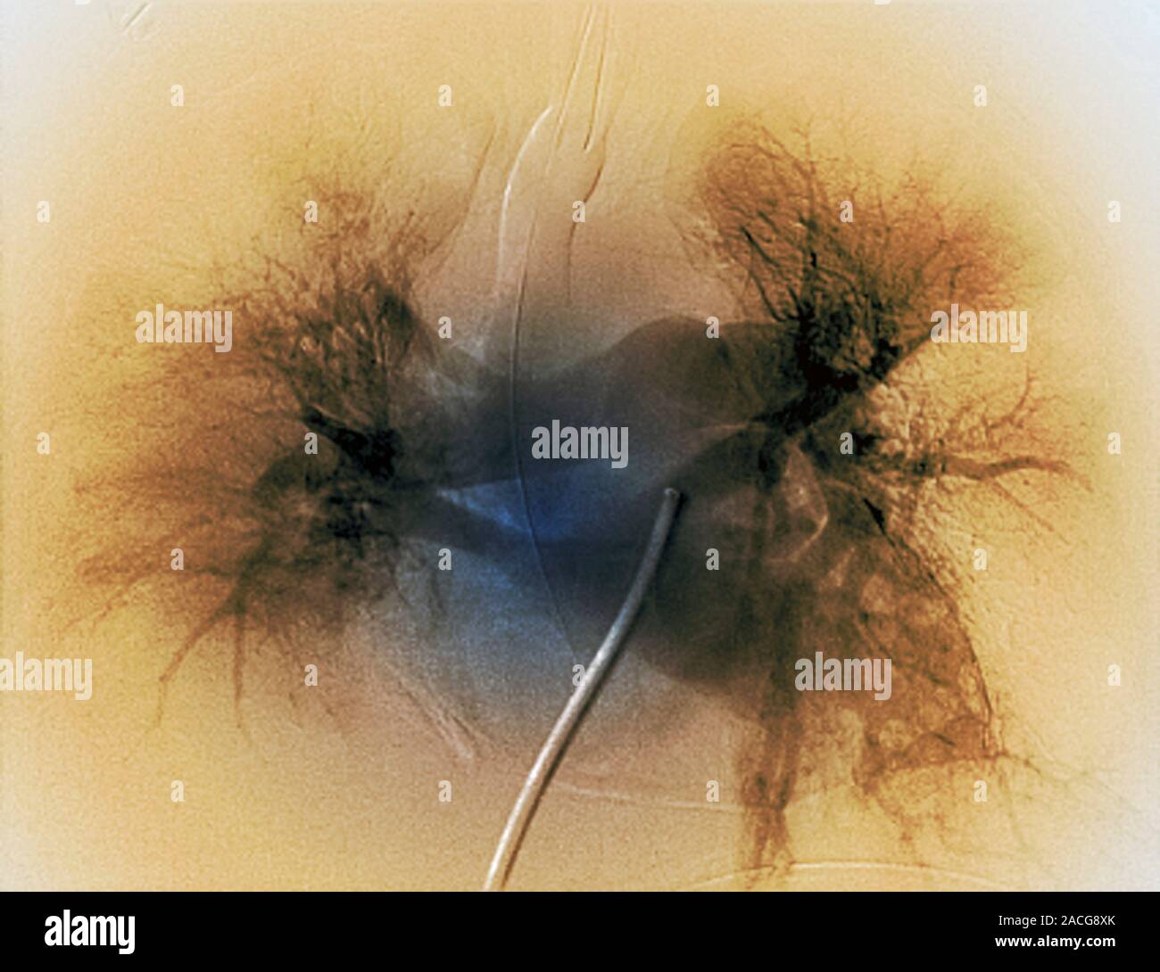 Coloured digitised pulmonary angiogram (X-ray) in front view of the ...