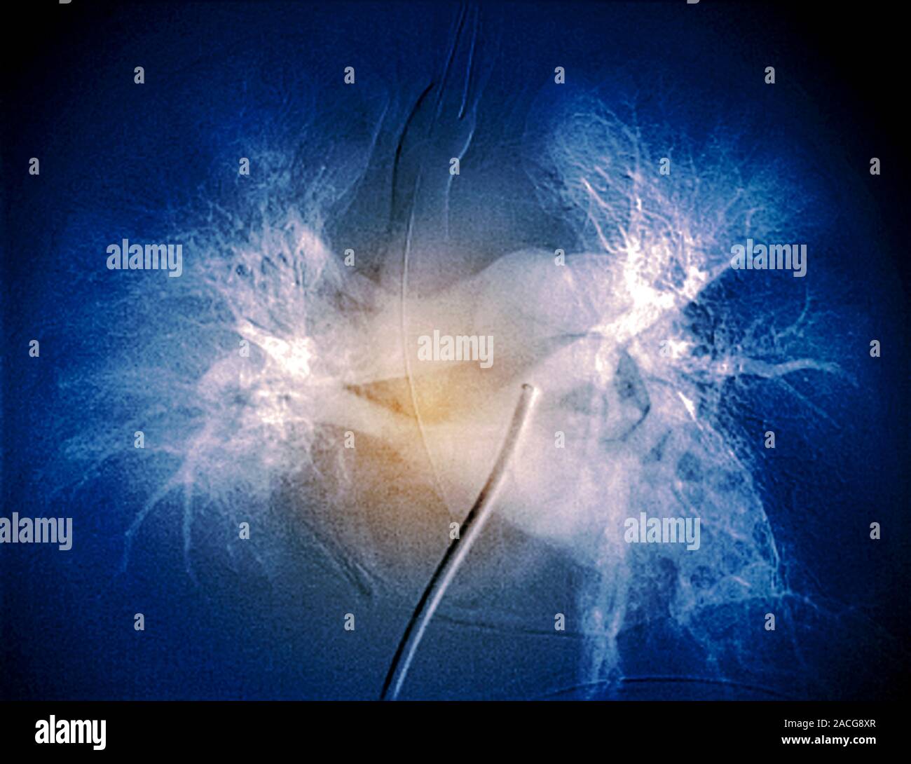 Coloured digitised pulmonary angiogram (X-ray) in front view of the ...