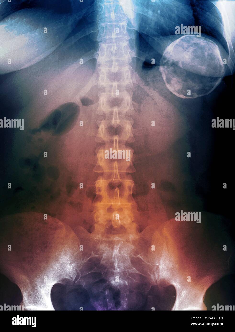 Coloured X-ray (front view) of the abdomen of a 35 year old patient ...