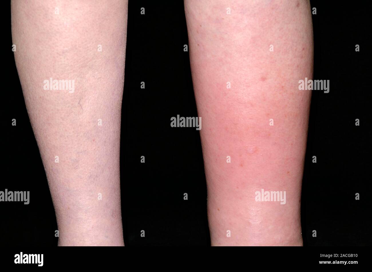 Red and inflamed leg of a 75 year old female patient, showing ...