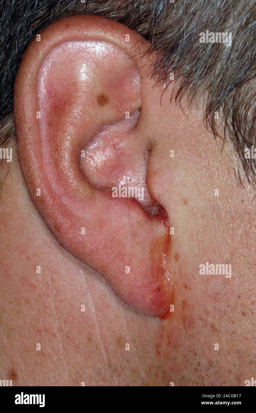 Ear Infection Discharge