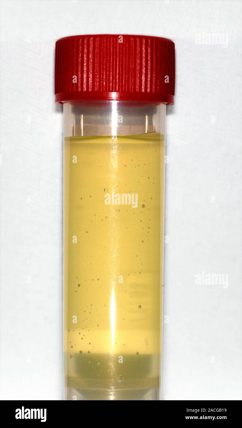 Specimen bottle of urine from a patient, showing slightly cloudy urine ...
